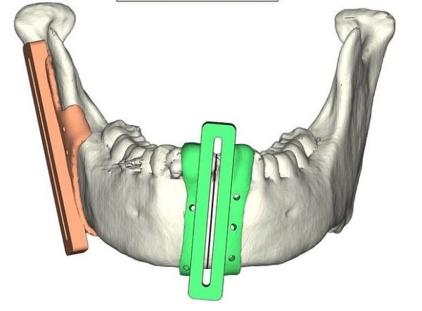 Osteotomy planning - IDDS 3D Printing